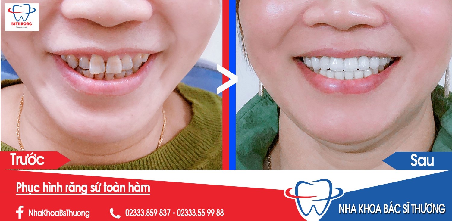 Các dạng phục hình răng sứ - Nha khoa BS Thương