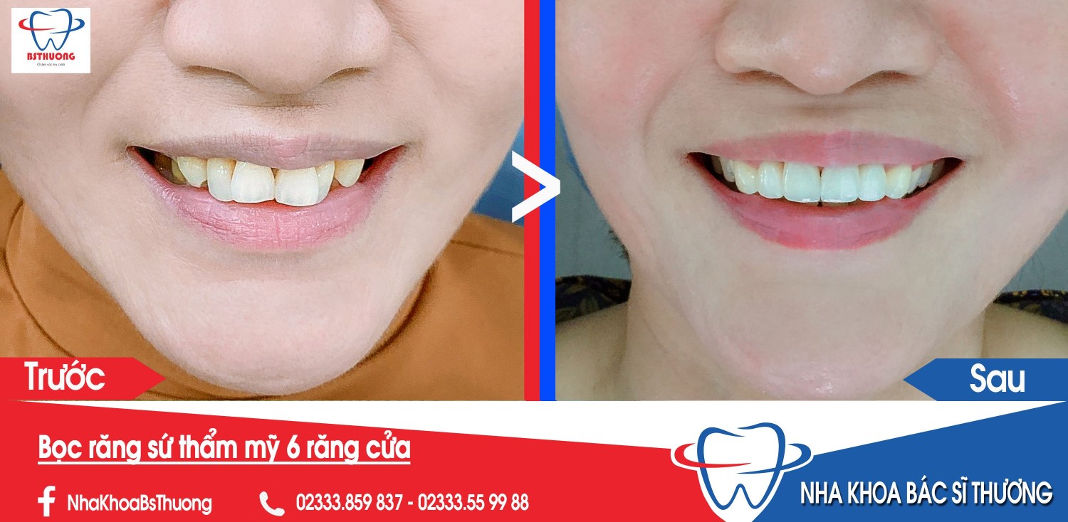 Các dạng phục hình răng sứ - Nha khoa BS Thương