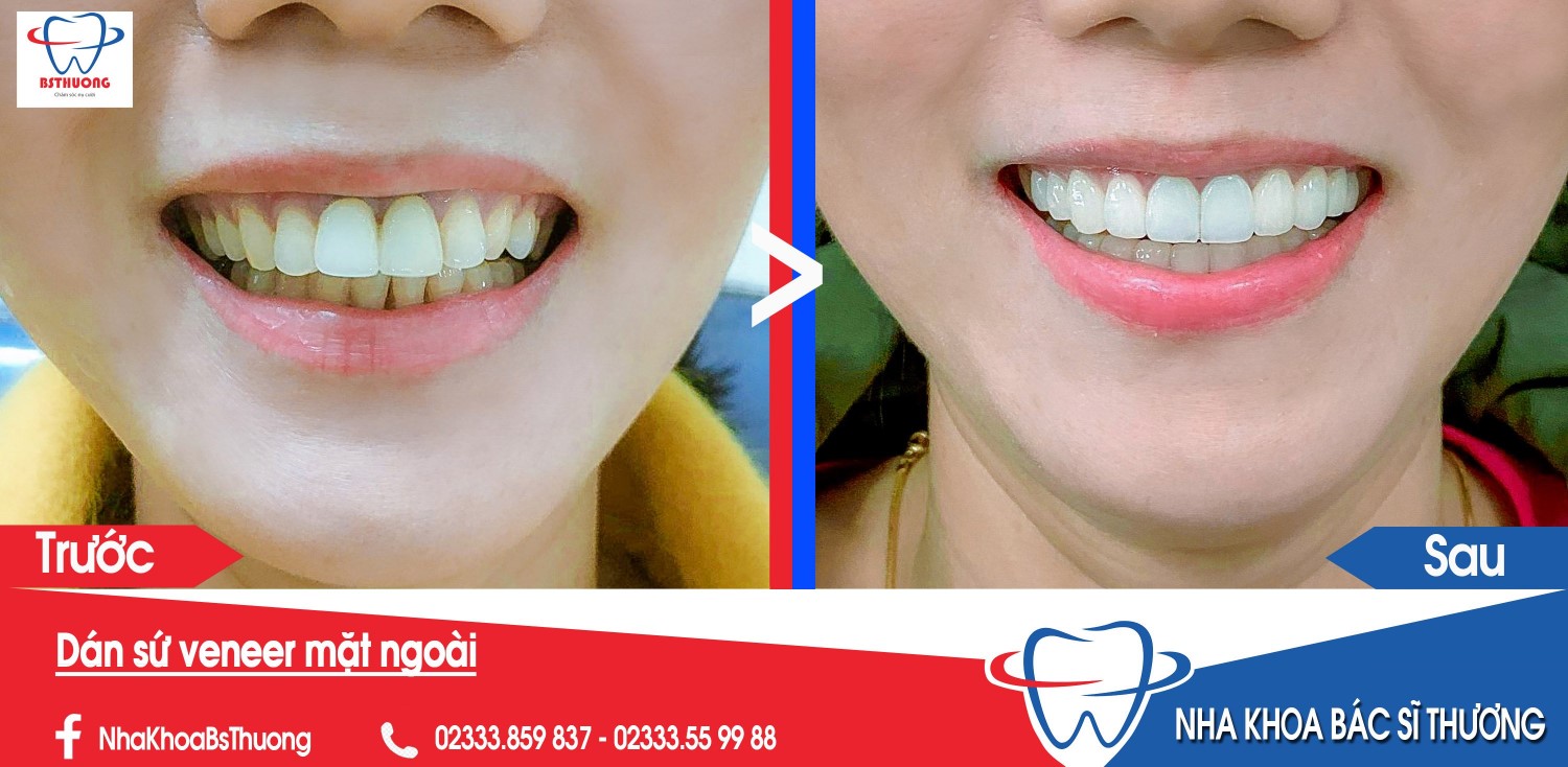 Các dạng phục hình răng sứ - Nha khoa BS Thương