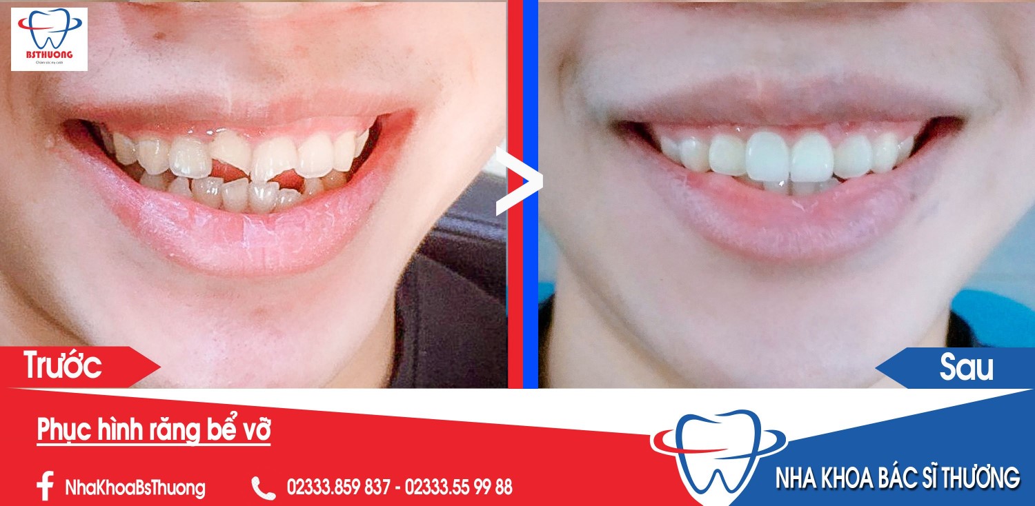 Các dạng phục hình răng sứ - Nha khoa BS Thương